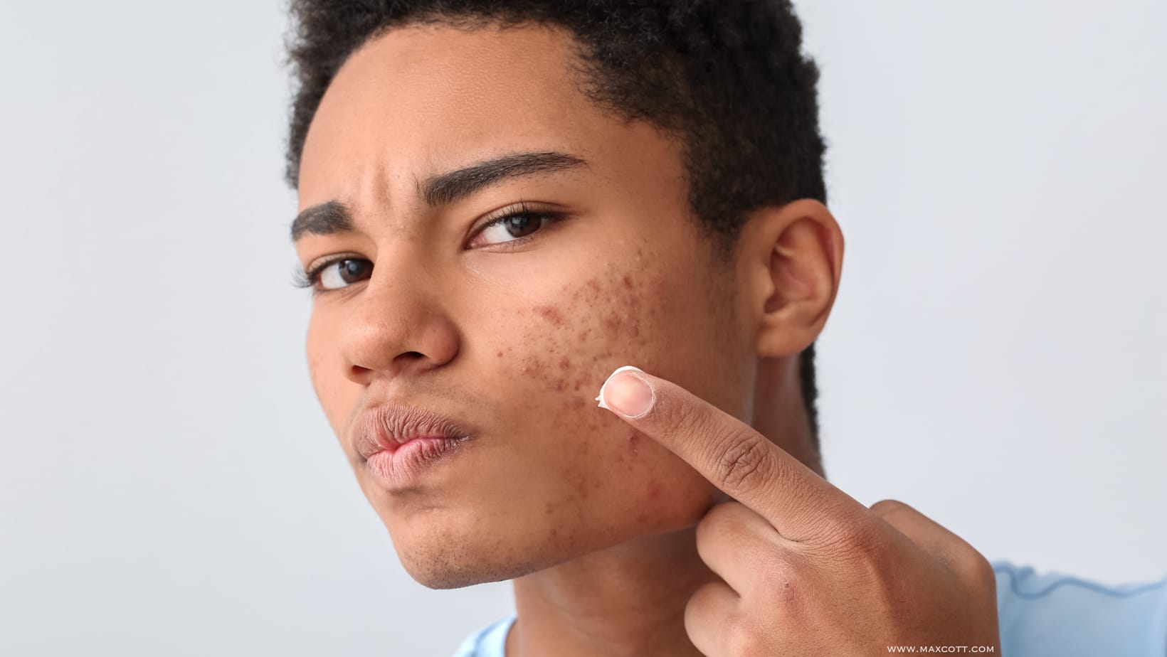 Lack Of Sex Causes Pimple In Men